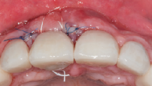 Dental Microscope – Ocala Periodontics & Dental Implants