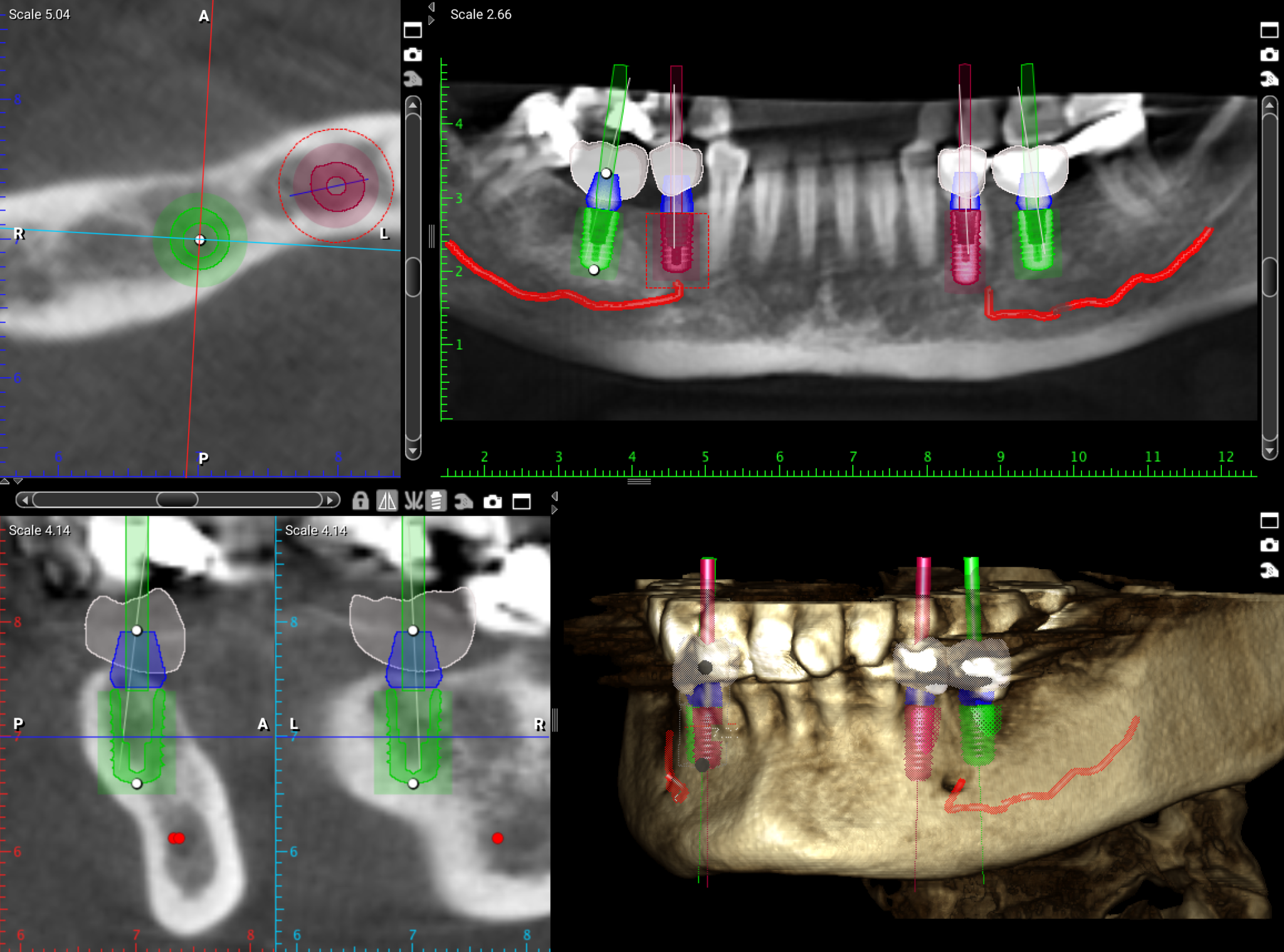 Computer Guided Surgery – Ocala Periodontics & Dental Implants